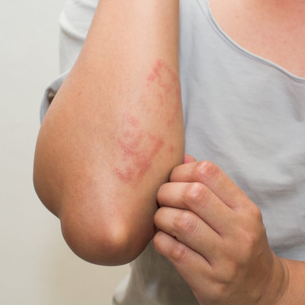 How genetic fingerprints can help doctors diagnose rashes more ...